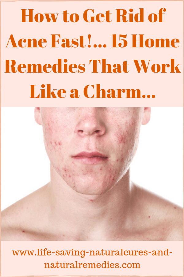 15 Natural Home Remedies for Acne That Work Like a Charm!