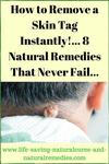 8 Stunning Home Remedies for Removing Skin Tags… Fast!